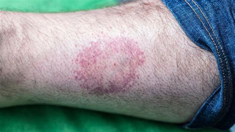 Skin Rash