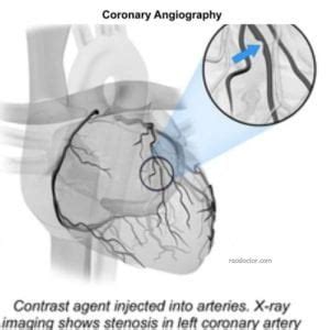 Coronary Artery Bypass Graft Surgery All You Wanted To Know