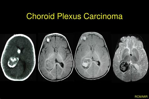 Ppt Choroid Plexus Carcinoma Powerpoint Presentation Free Download Id5140016 Ppt Choroid Plexus Carcinoma Powerpoint Presentation Free Download Id5140016