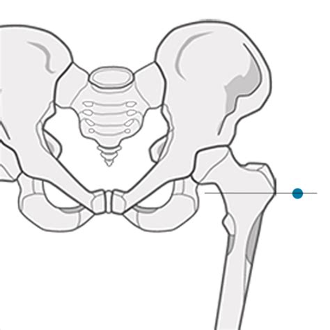 X Ray Calibration Marker At Johnny Moe Blog