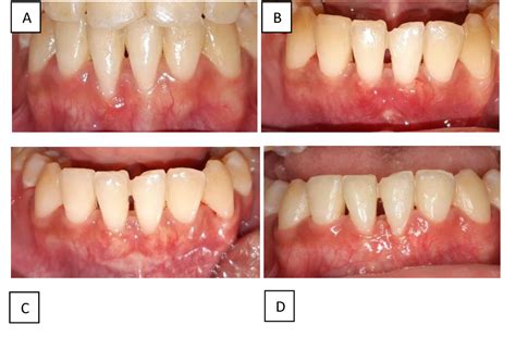 Figure 1 From Root Coverage Using Modified Tunneling Technique With Acellular Dermal Matrix For