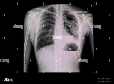 Left Hemothorax X Ray