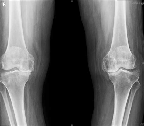 Advanced Oa Knee Docjointsdr Sujit Josjoint Surgeon For Shoulder Knee And Hip Sports