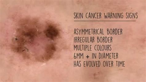 What Is Considered Early Detection For Skin Cancer At Aaron Edwards Blog