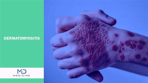 Dermatomyositis Mdmedicine Tv