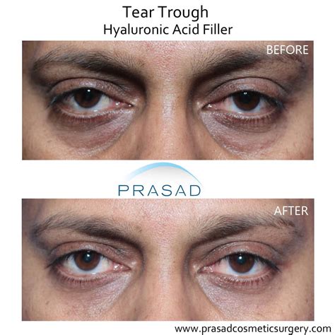 Eyes Dark Circles Before After