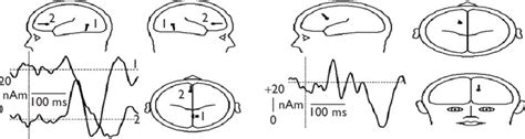 Left Results Of The Dipole Source Analysis Of The Di¡erence Wave Download Scientific Diagram