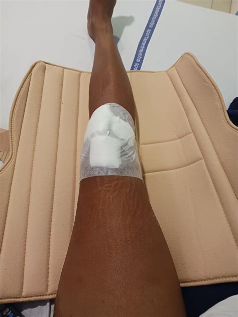 Acl Reconstruction Trimming Meniscus R Acl