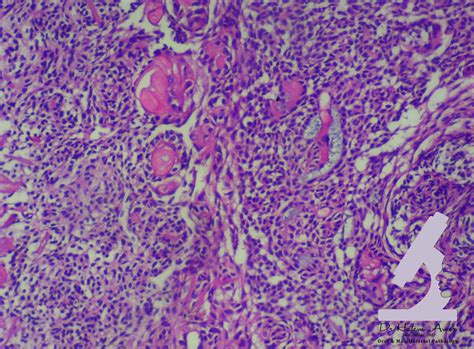 A Case Of Calcifying Odontogenic Cyst Gorlin Cyst Arising In The