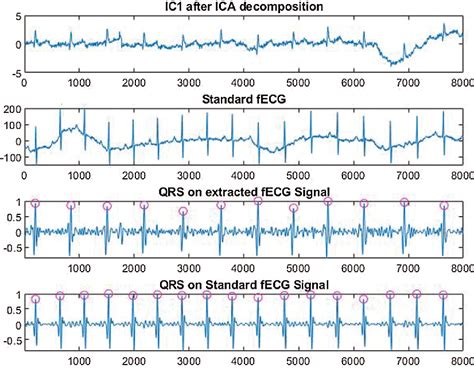 Figure 7 From Design And Realization Of Non Invasive Fetal Ecg Monitoring System Semantic Scholar