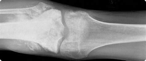 Bone Sarcoma What Is Sarcoma The London Sarcoma Service