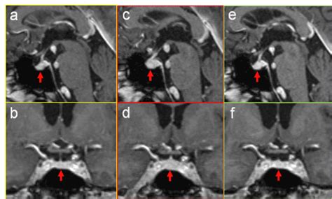 Ipilimumab Causing Autoimmune Hypophysitis A Case Report