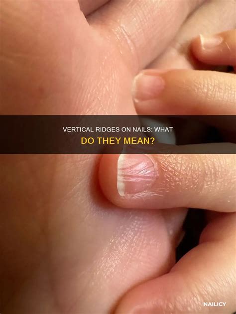 Vertical Ridges On Nails What Do They Mean Nailicy