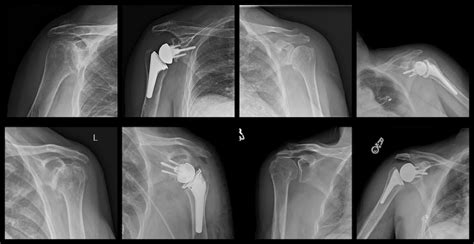 Dr Mcclintocks Shoulder X Ray Image Gallery Kyle Mcclintock Do Orthopedic Surgeon