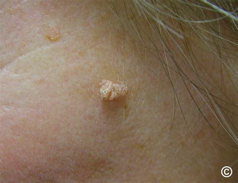 Warts