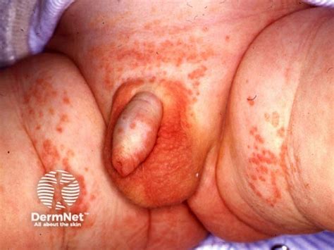 Napkin Dermatitis Image