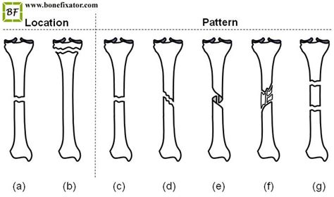 Bone Fracture Types Bone Fracture Types Of Fractures Fracture