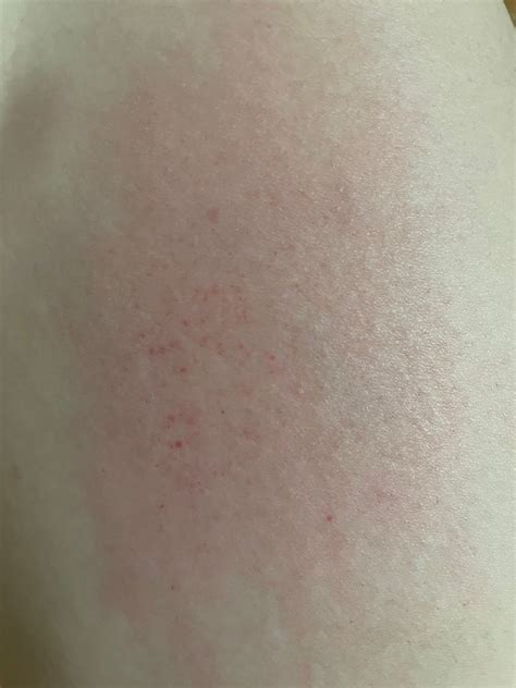 허벅지 두드러기 지식in