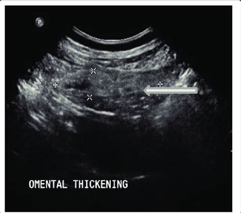 B The Abdominal Ultrasound Showing A Hyperechoic Mass Under The Right Download Scientific