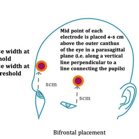 Shows The Positioning Of A Right Unilateral Rul Electrode Placement [36] Download