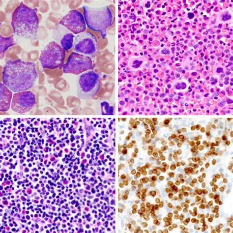 A B Bone Marrow Smears Showing Marked Eosinophilia Matured Myeloid