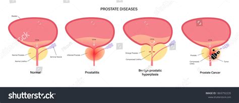 Prostate Disease Types Normal Bladder Prostatitis Stock Vector Royalty Free 1869792235