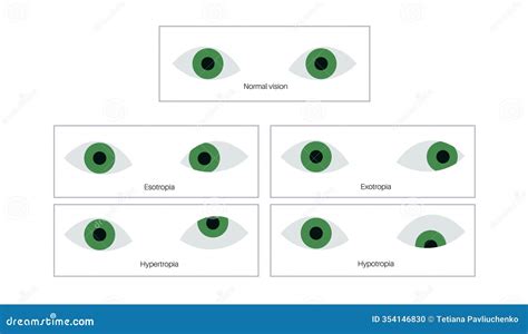 Strabismus Eye Misalignment Icon In Line Design Strabismus Misalignment Squint Binocular