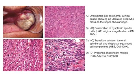 Histopathological Variants Of Squamous Cell Carcinoma Doctor Faris Alabeedi Msc Mmedsc Pgdip