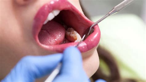 What Does Dry Socket Look Like After Wisdom Tooth Extraction