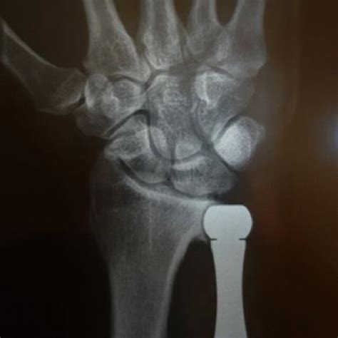 Migration Of The Ulnar Head Prothesis In The Distal Radius Download