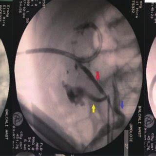 Retrograde Pyelogram Demonstrates Triplicate Of Ureters And Download Scientific Diagram