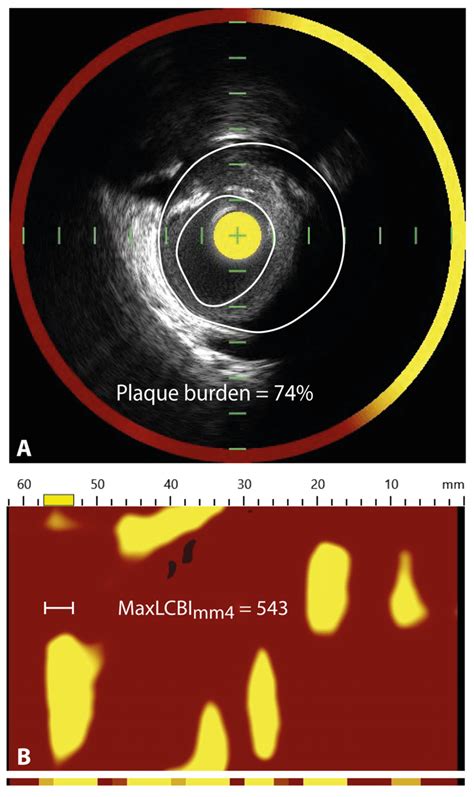 Vulnerable Plaque On Nirs Ivus A Displays An Intravascular Download Scientific Diagram