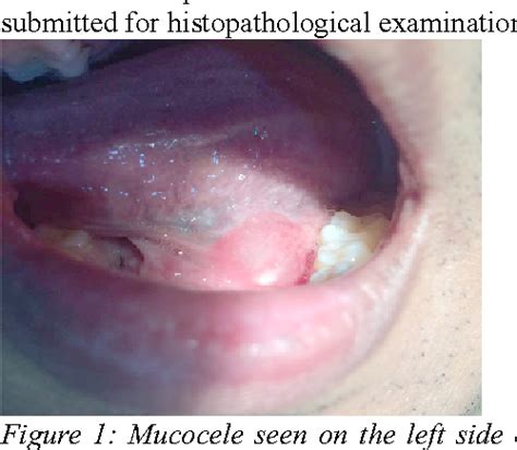 Figure 1 From Salivary Cyst Of Floor Of Mouth A Case Report Semantic Scholar