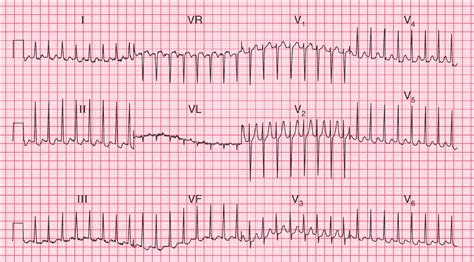 Ecg Case 101 Lown Ganong Levine Lgl Syndrome Manual Of Medicine