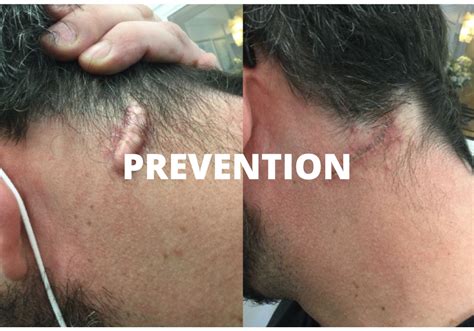 What Causes Keloids On Ears And How To Avoid Them London Keloid Scar