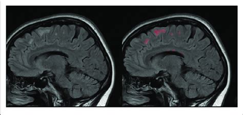 Example Of Mri Slices And Ground Truth Segmentation From Ms Dataset