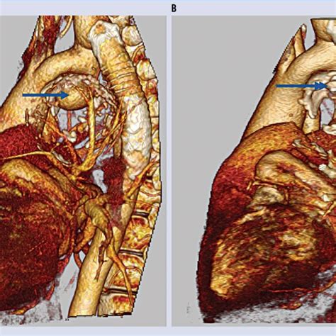 Computed Tomography Volume Rendering Reconstruction Showing The Anatomy