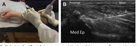 Figure 1 From Ultrasound Guided Elbow Procedures Semantic Scholar