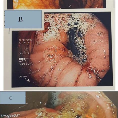 Gastroscopy Showing A Duodenum B Pylorus And C Pylorus Blue