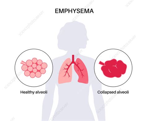 Emphysema Illustration Stock Image F0402935 Science Photo Library