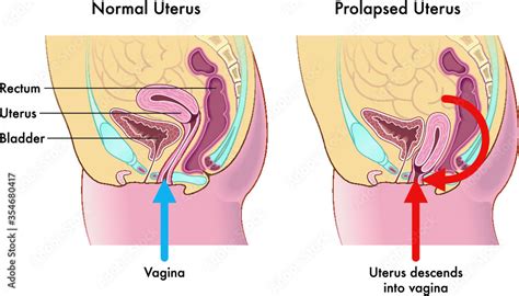 Medical Illustration Showing The Difference Between A Normal Uterus And