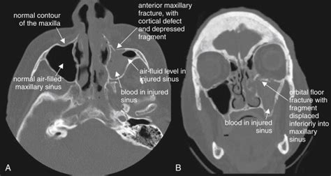 Face Bone Anatomy Ct