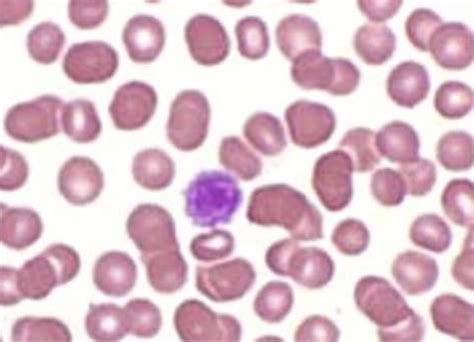 Hematology Platelet Disorders Of Number And Function Flashcards Quizlet