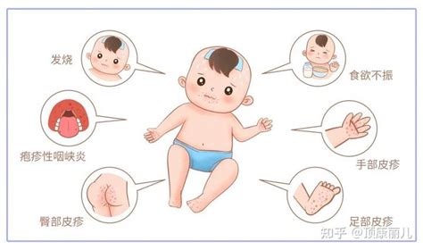 夏秋季高发的手足口病和疱疹性咽峡炎你还分不清吗 知乎