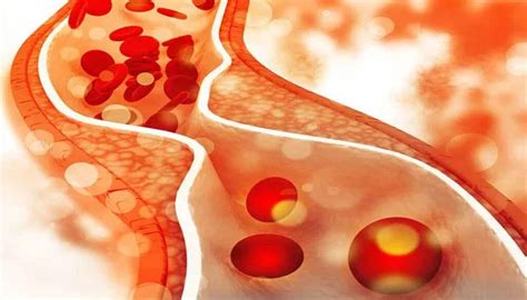 What Body System Is Hyperlipidemia