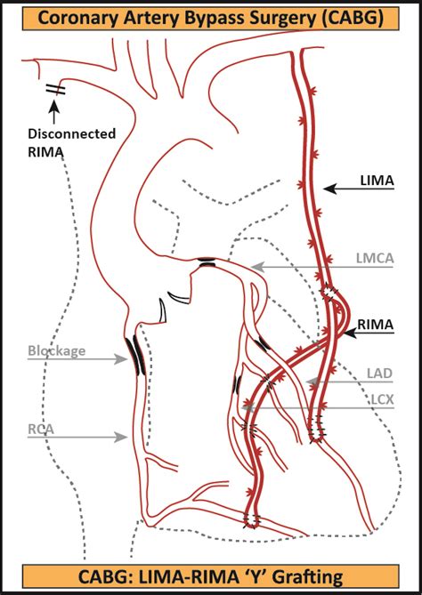 Minimally Invasive Bypass Surgery Micas