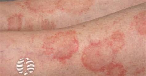 Pigmented Purpuric Dermatitis Image