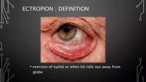 Ectropion Pptx