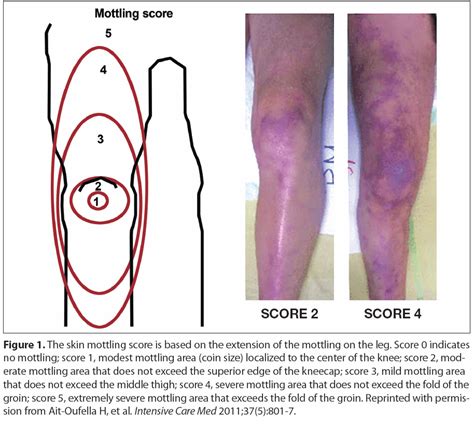 Mottling