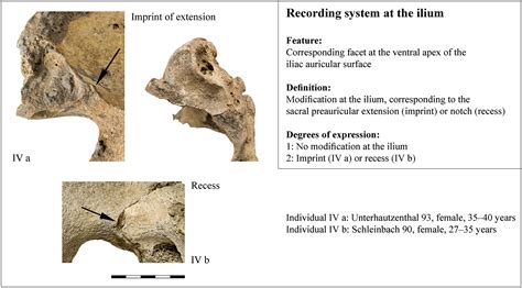 Preauricular Sulcus